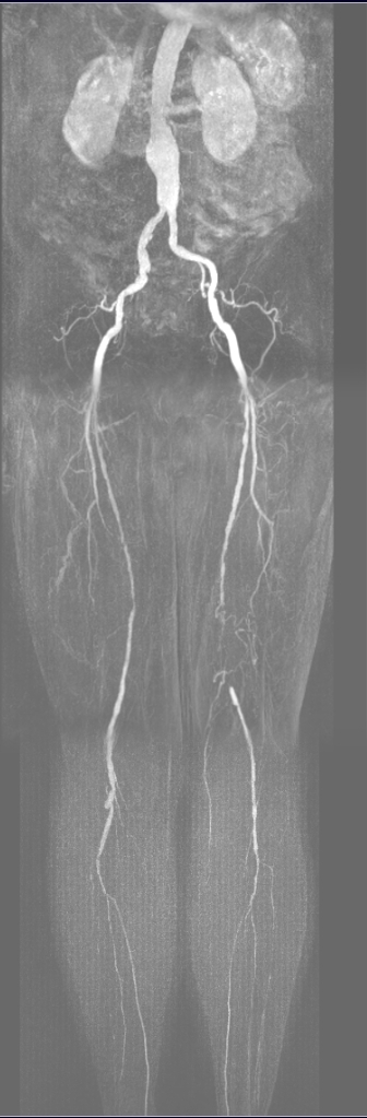 angiografi – Store medisinske leksikon