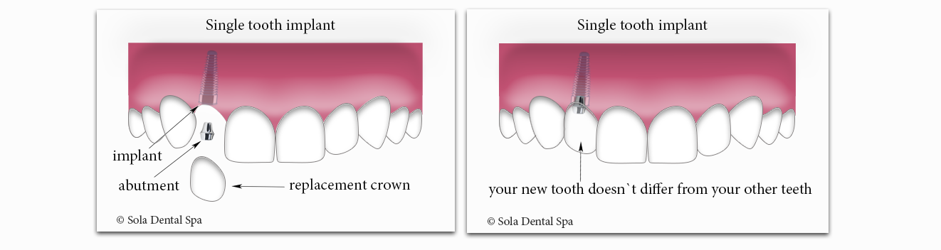 Single-tooth-implant - Sola Dental Spa