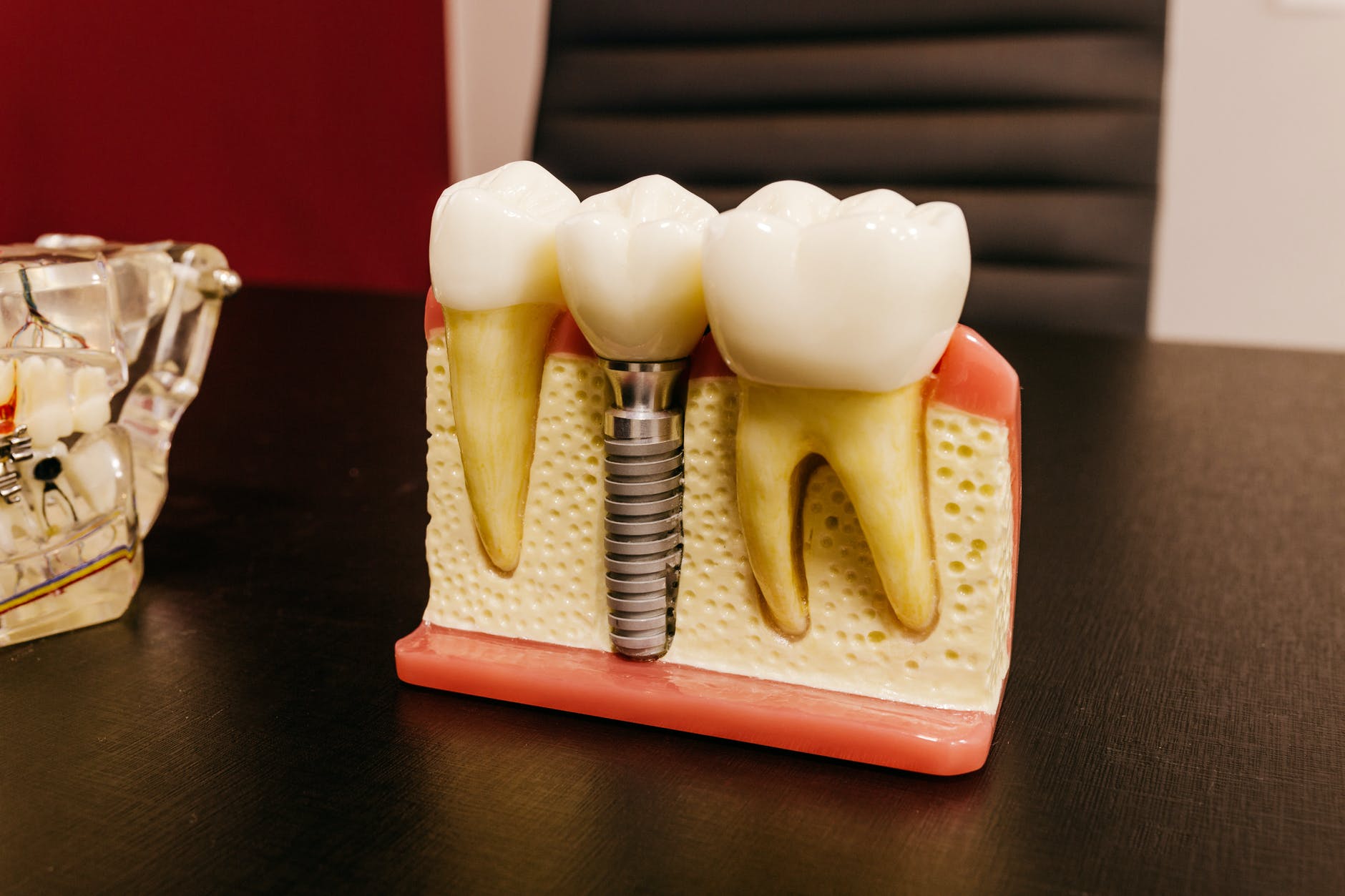 Dental Implant Procedure (Surgery) in Staten Island - Sola Dental Spa