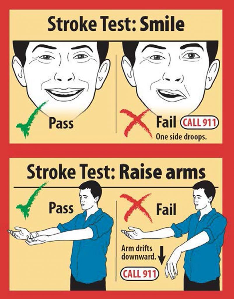 From Stroke Smart Alexandria to a Stroke Smart World