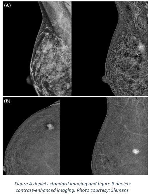 Contrast-enhanced mammography offered at Atrium Health Wake Forest ...