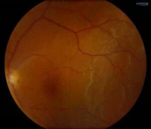Zhang Ring Test™ for Early Diagnosis of Retinal Detachment - Precision ...
