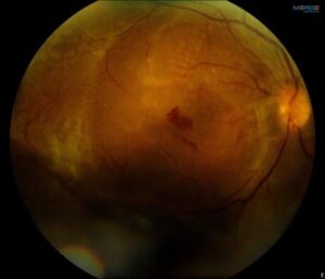 Zhang Ring Test™ for Early Diagnosis of Retinal Detachment - Precision ...