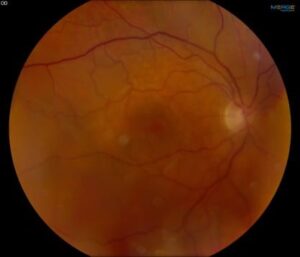 Zhang Ring Test™ for Early Diagnosis of Retinal Detachment - Precision ...