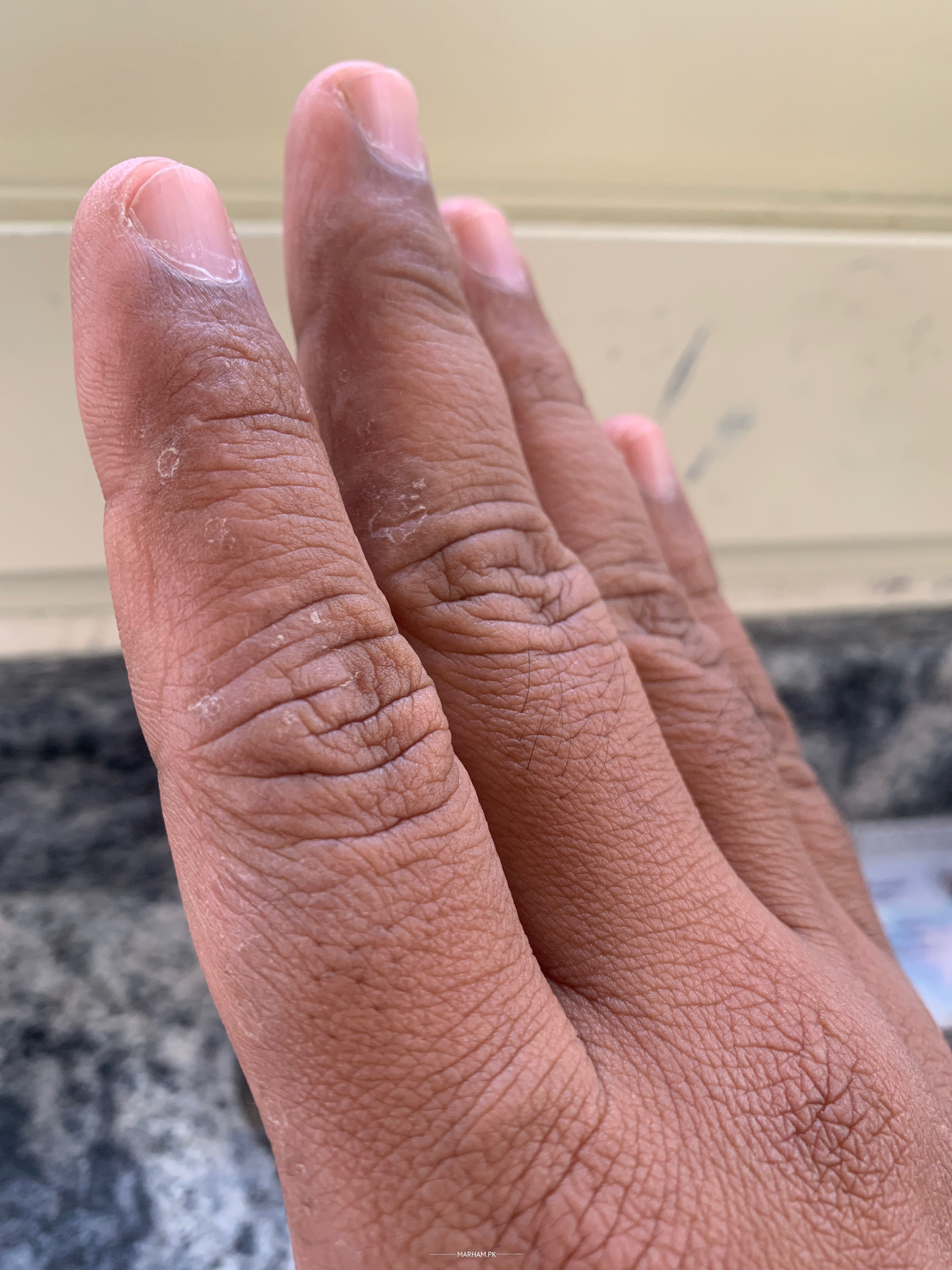 Ask a Dermatologist Online for Finger Skin