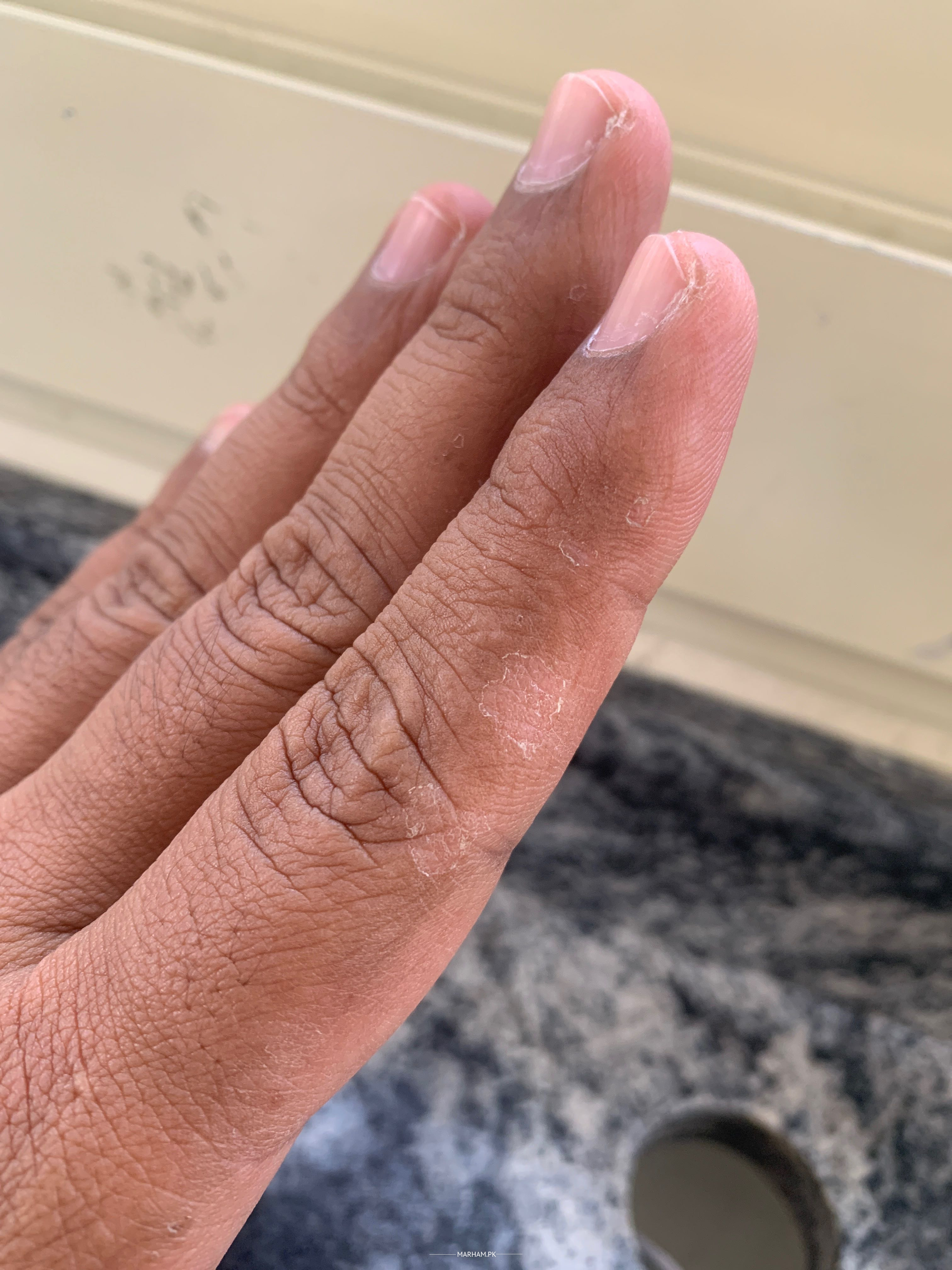 Ask a Dermatologist Online for Finger Skin
