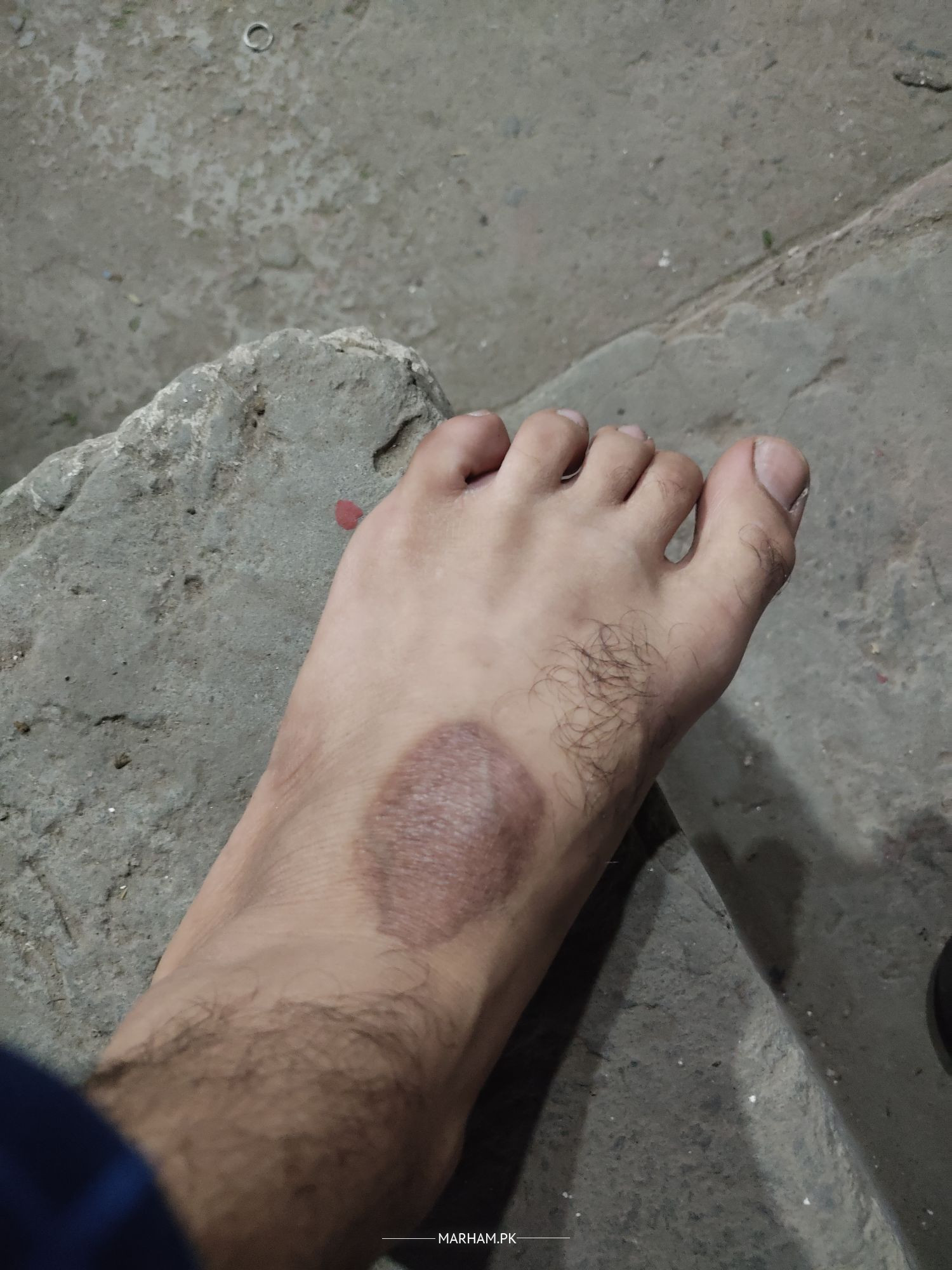 Ask a Dermatologist Online for Accident Mark