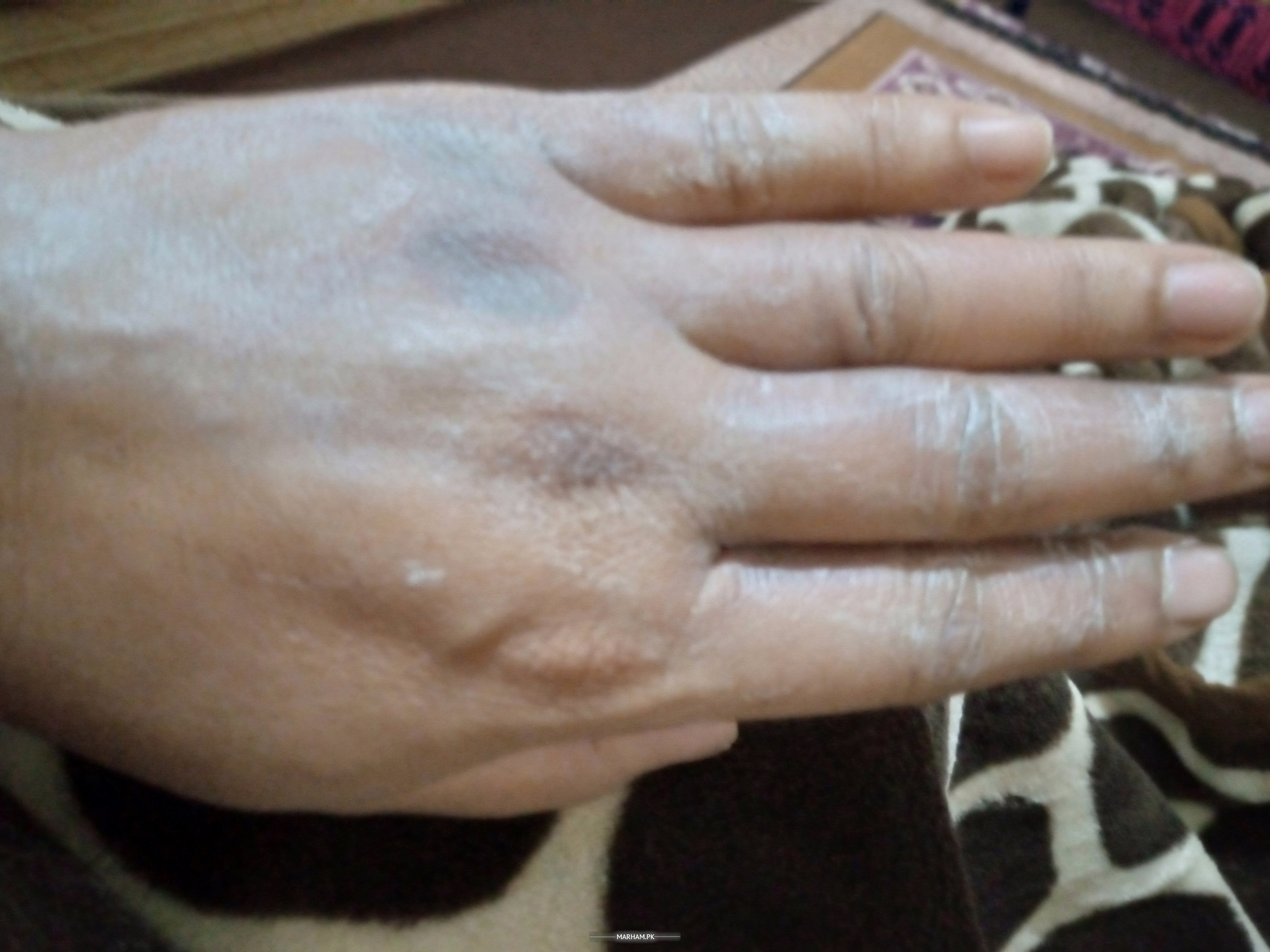 Ask a Dermatologist Online for How To Remove Burn Marks