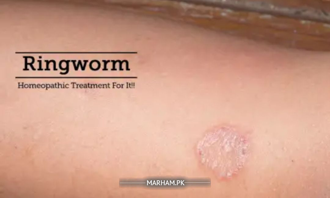 Ask a Dermatologist Online for Severe Eczema