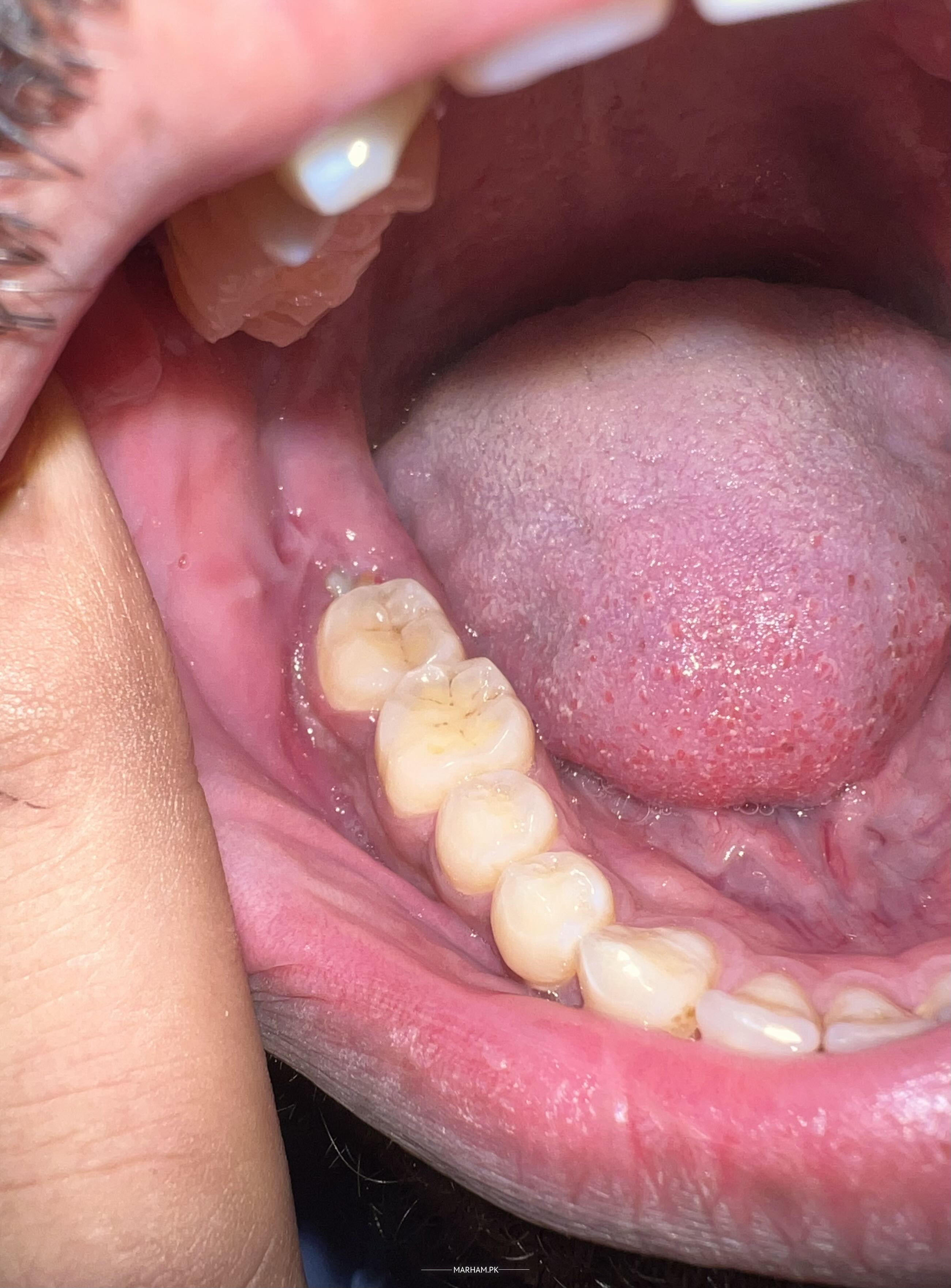 Ask a Dentist Online for Wisdom Tooth Pain Swelling