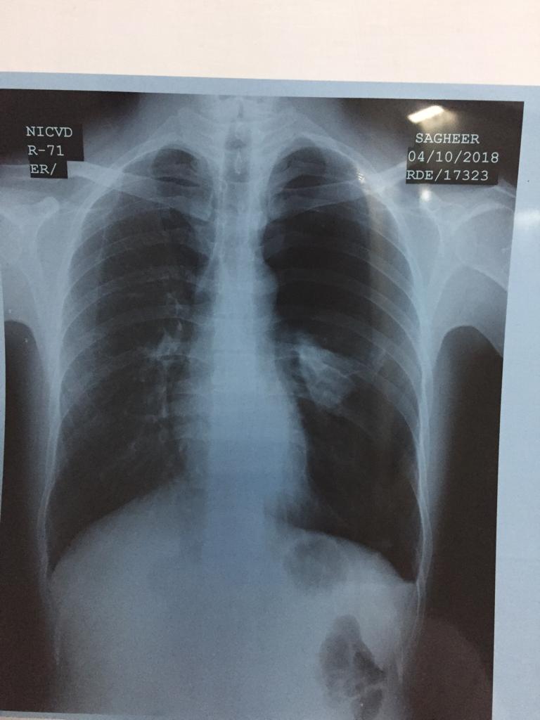 Ask a Pulmonologist / Lung Online for Pain In Left Side Chest