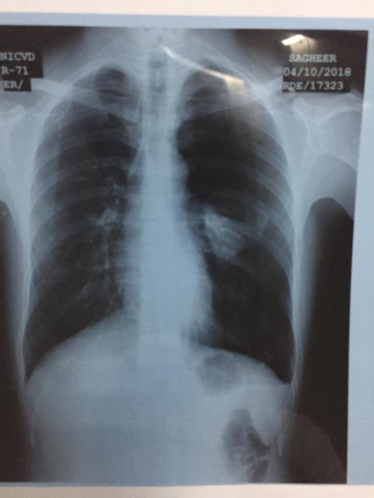 Ask a Pulmonologist / Lung Online for Pain In Left Side Chest