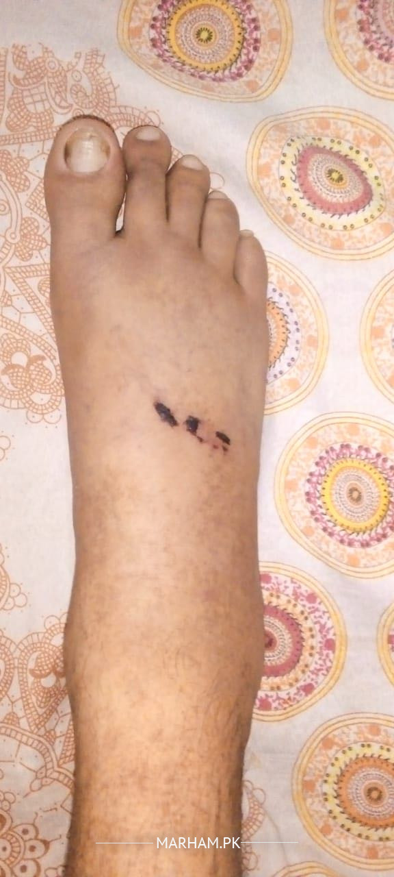 Ask a Cosmetic Surgeon Online for Foot Injury