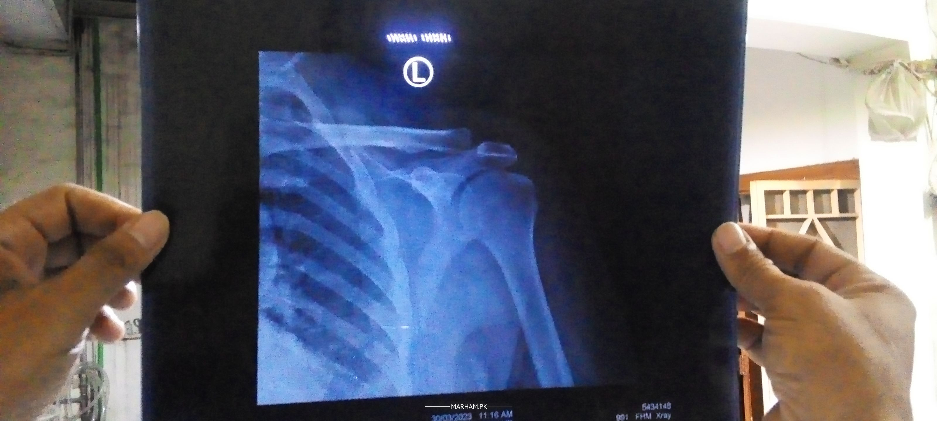 Ask a General Physician Online for Check This X-ray Report