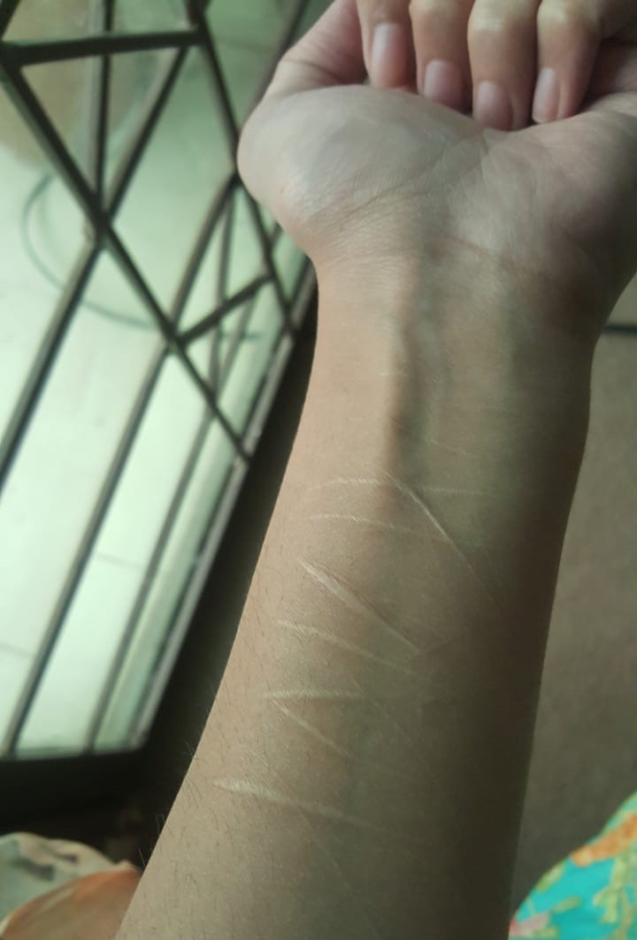 Ask a Dermatologist Online for Scars From Self Harm