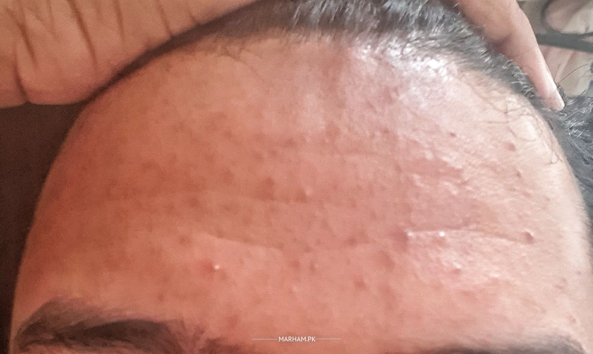 Ask a Dermatologist Online for Forehead Sudden Pimples Spurt