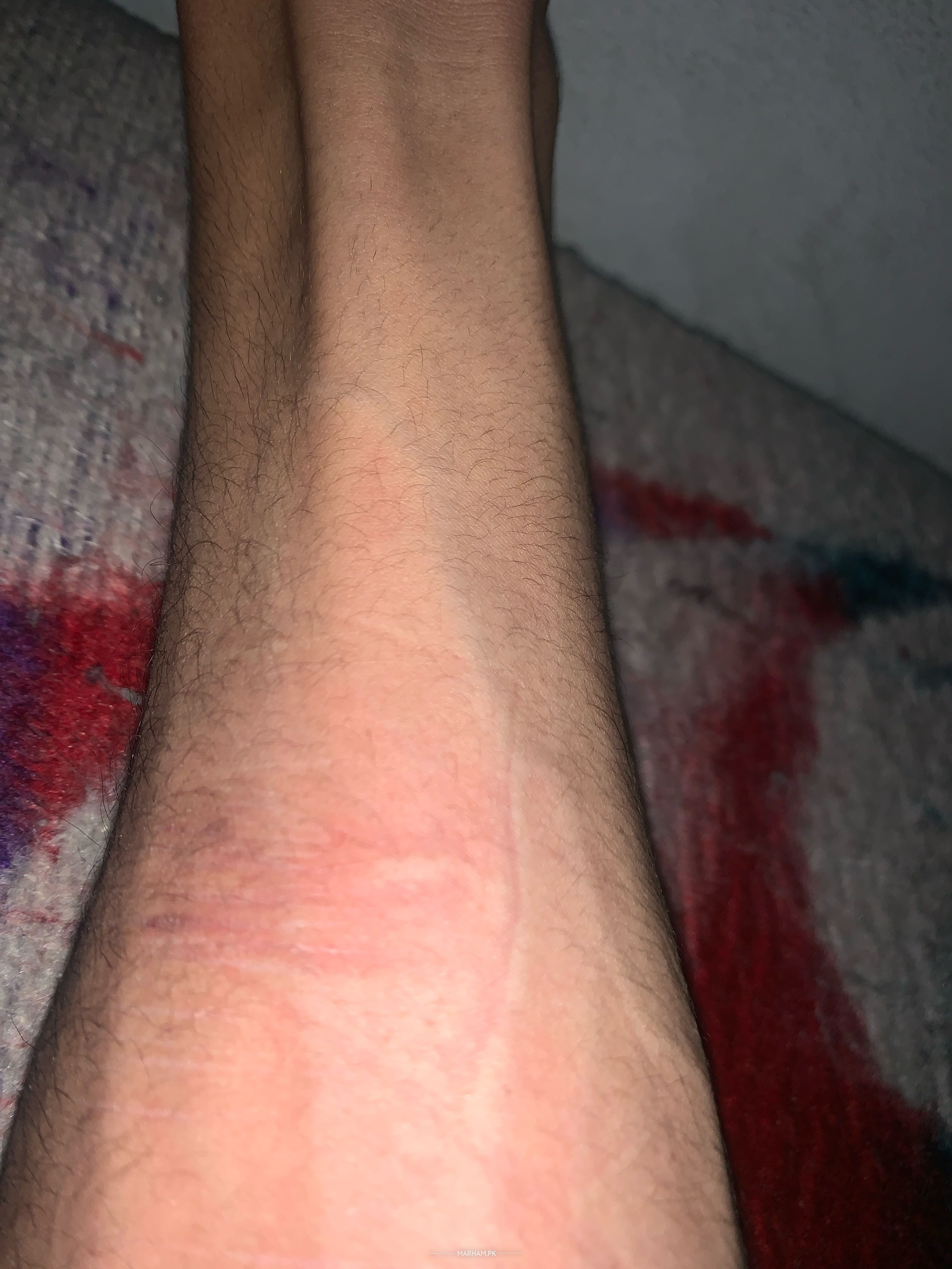 Ask a Skin, nails, Hair, Dermatology Online for Cuts On Arms