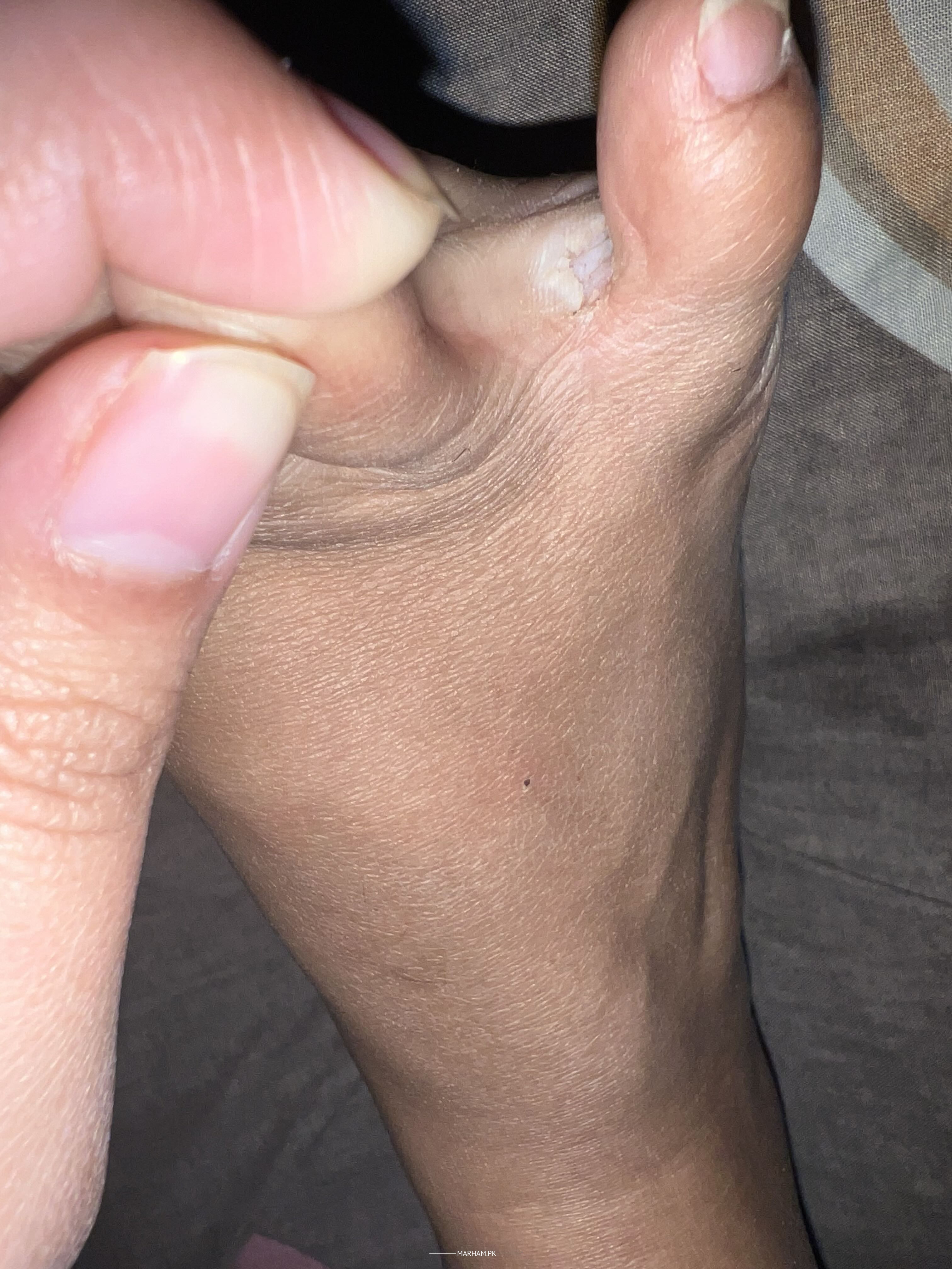 Ask a Dermatologist Online for Skin Peeling Between Pinky Toe