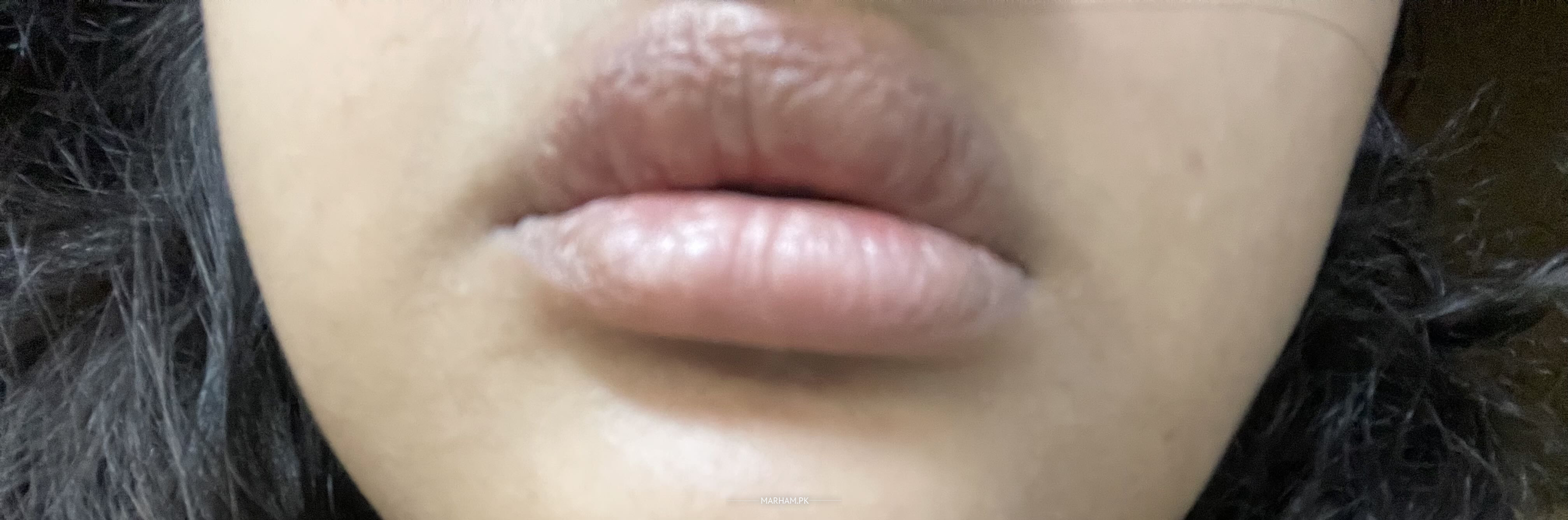 Ask a General Physician Online for Swollen Lips And Lower Eyelid