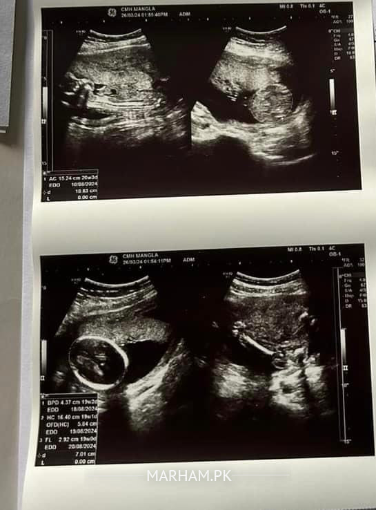 Ask a Gynecologist Online for Asking For Gender From 19 Week Scan