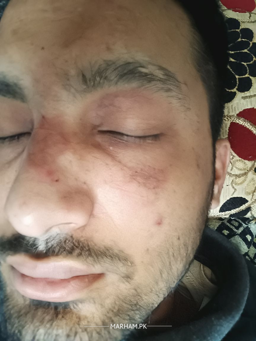 Ask a Dermatologist Online for Face Burnt By Geyser Blast