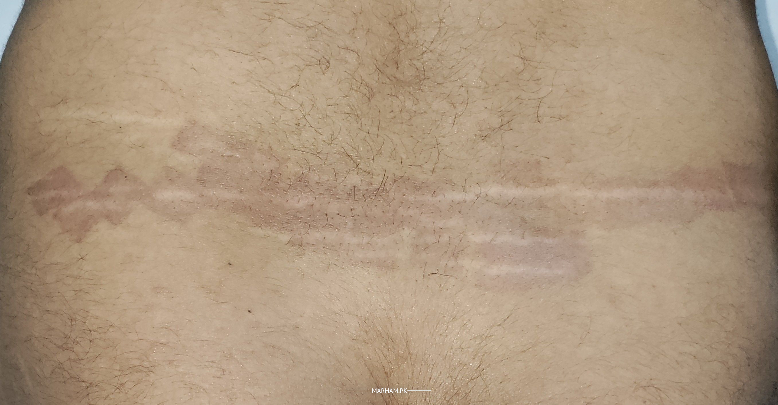 Ask a Dermatologist Online for Body Scratch Marks