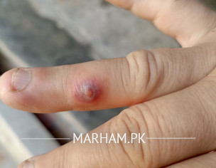 Ask a Dermatologist Online for Hand Pimples