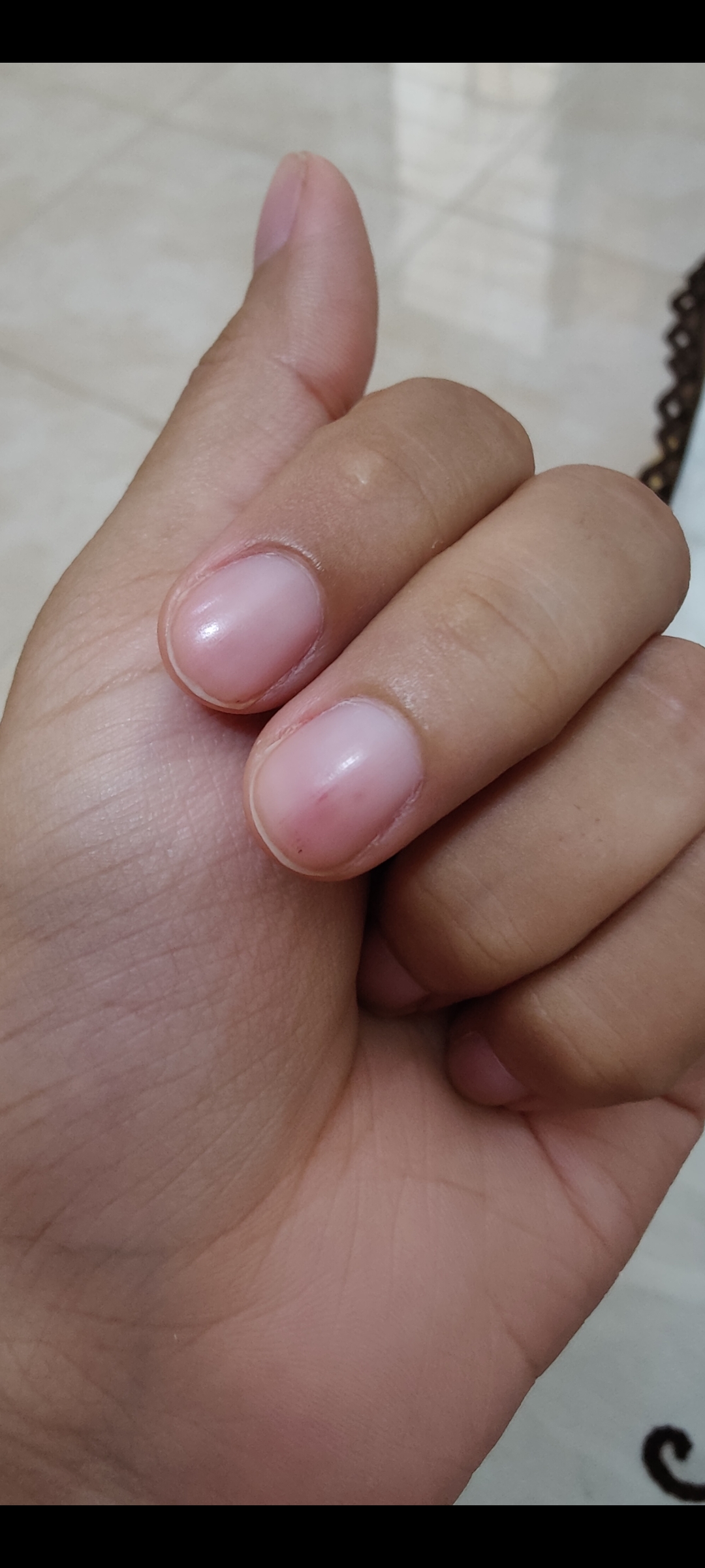 Ask a Dermatologist Online for Splinter Hemorrhage