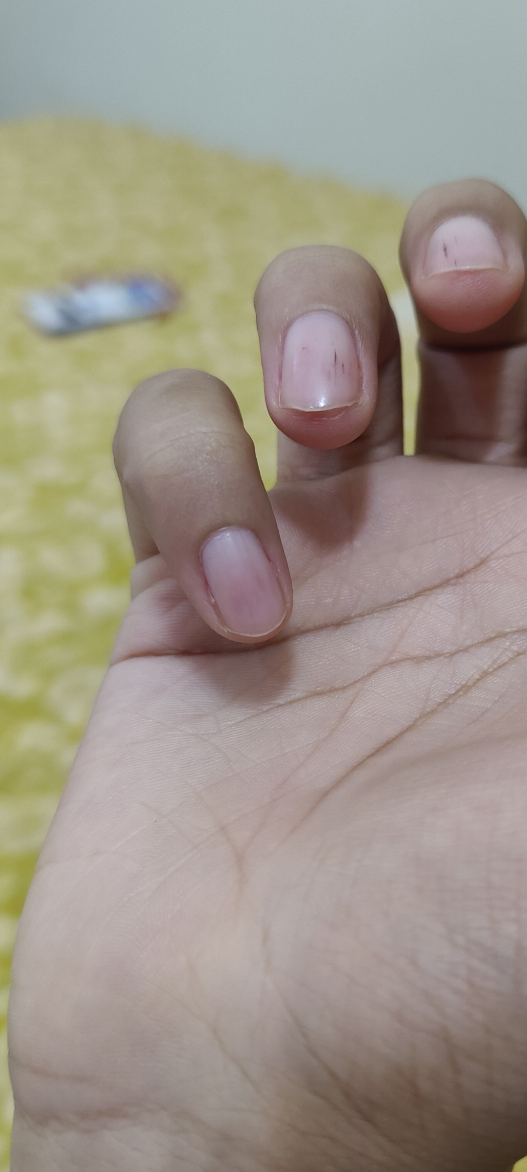 Ask a Dermatologist Online for Splinter Hemorrhage