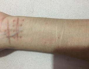 Ask a Dermatologist Online for Stitches Scars