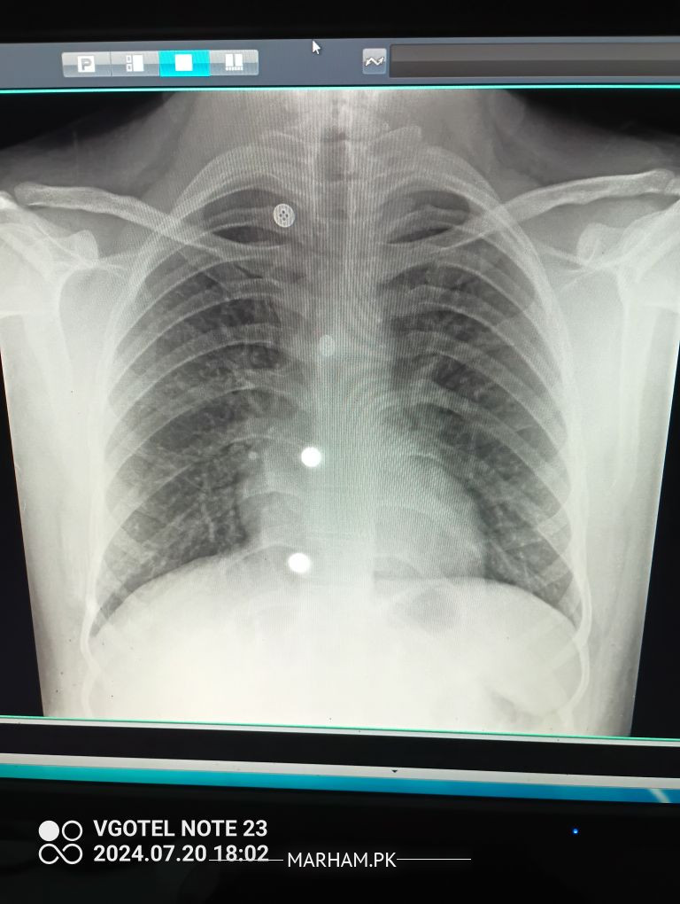 Ask a Pulmonologist / Lung Online for Cough And Mocus