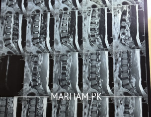 Ask a Neuro Physician Online for Sciatica (left Leg)