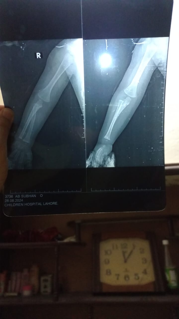 Ask a Orthopedic Surgeon Online for Bone Fracture In Arm