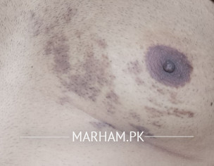 Ask a Dermatologist Online for Chest Mark