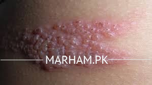 Ask a Gynecologist Online for Small Water Blisters