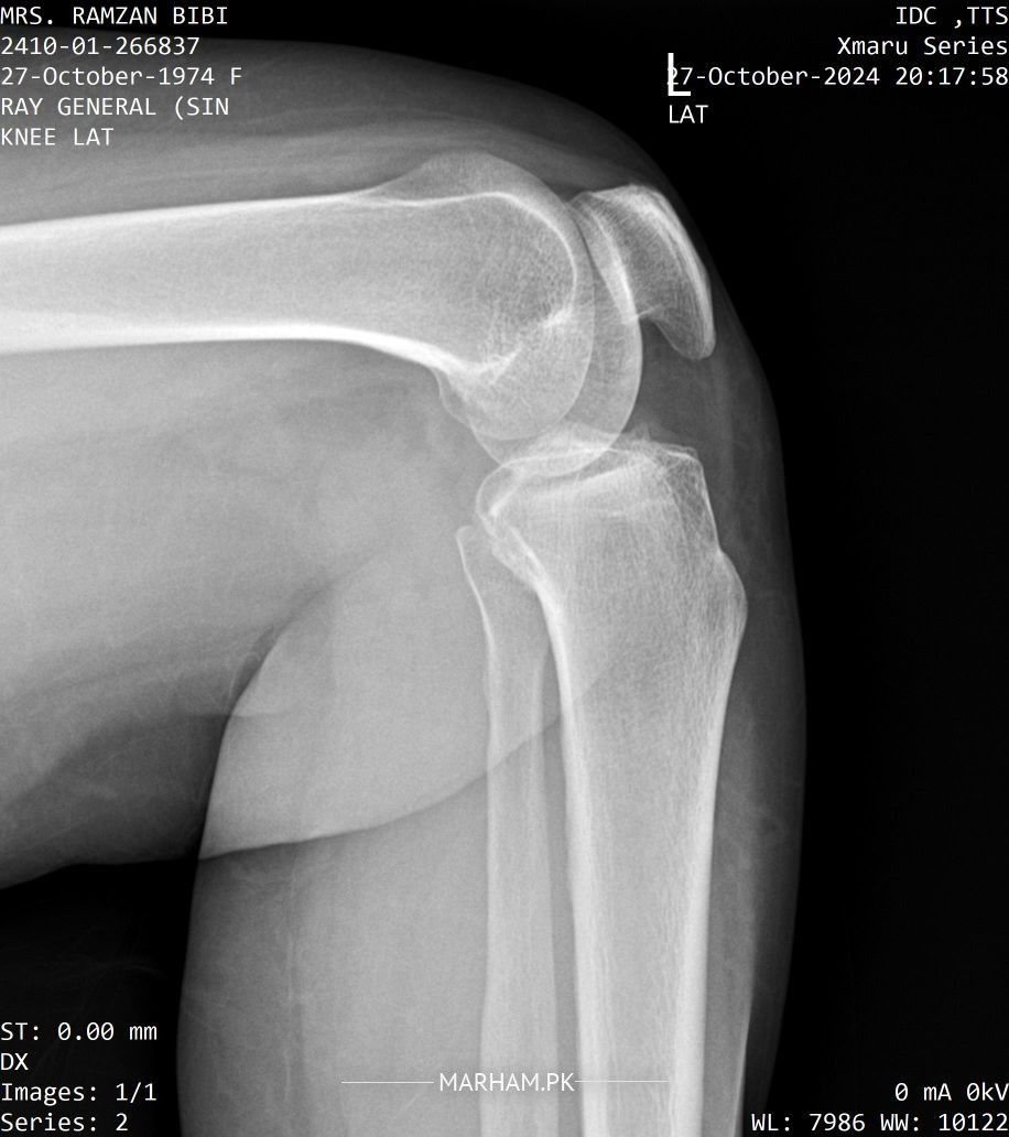 Ask a Orthopedic Surgeon Online for Knee X-ray Check