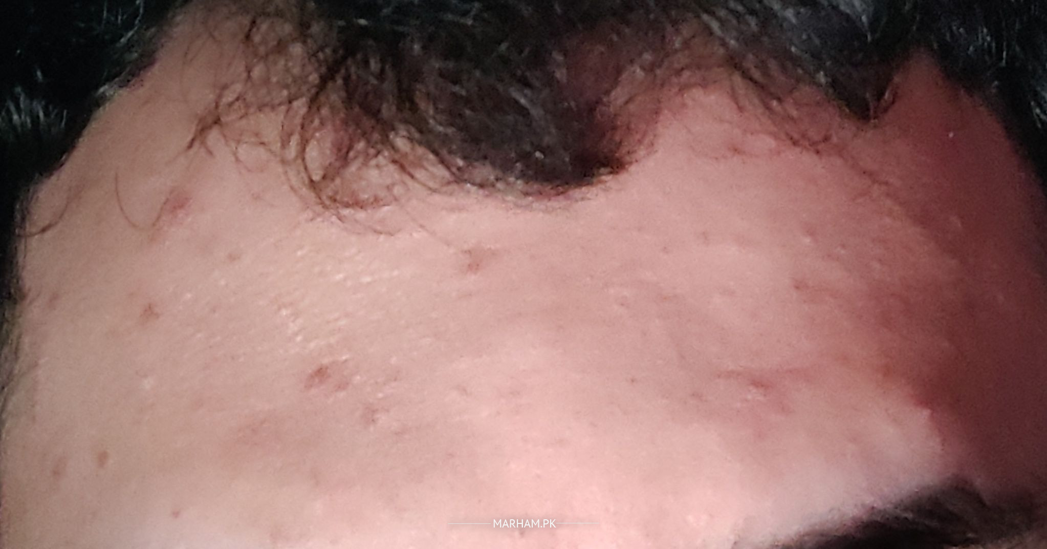 Ask a Dermatologist Online for Spots On Forehead