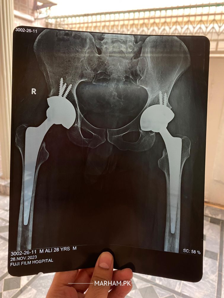 Ask a Orthopedic Surgeon Online for Hip Replacement X-ray Check