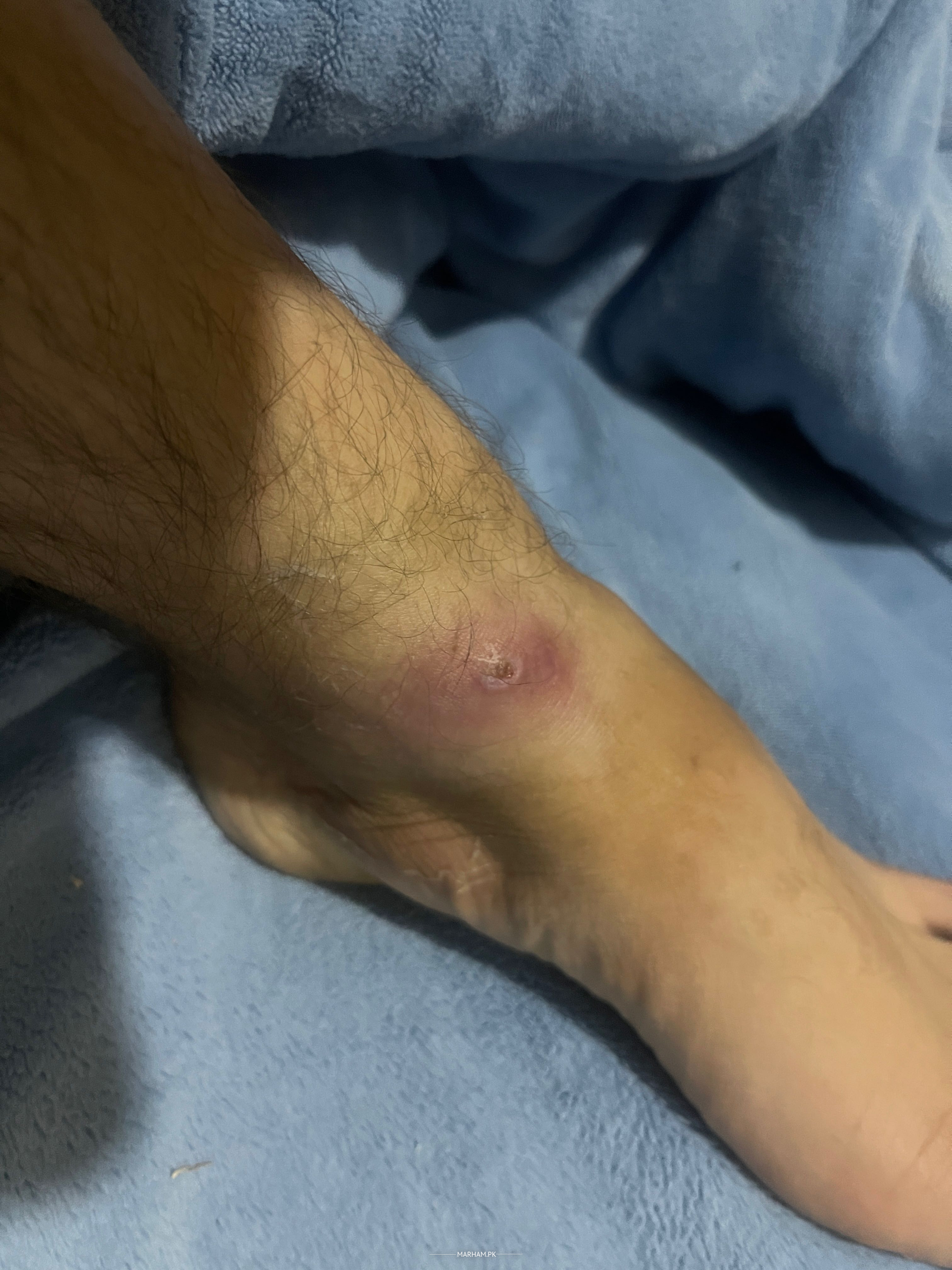 Ask a General Physician Online for Infected Wound