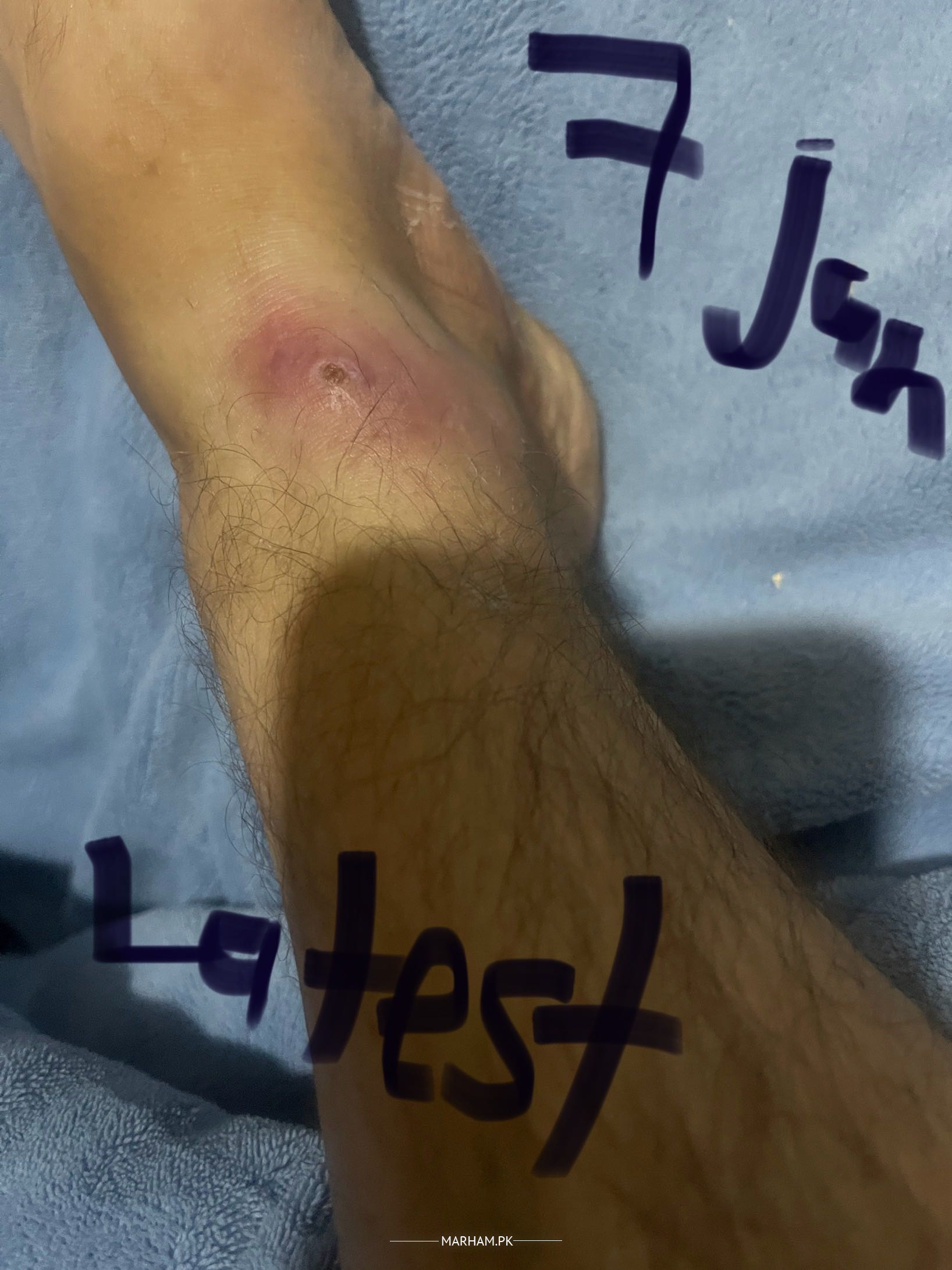 Ask a General Physician Online for Infected Wound