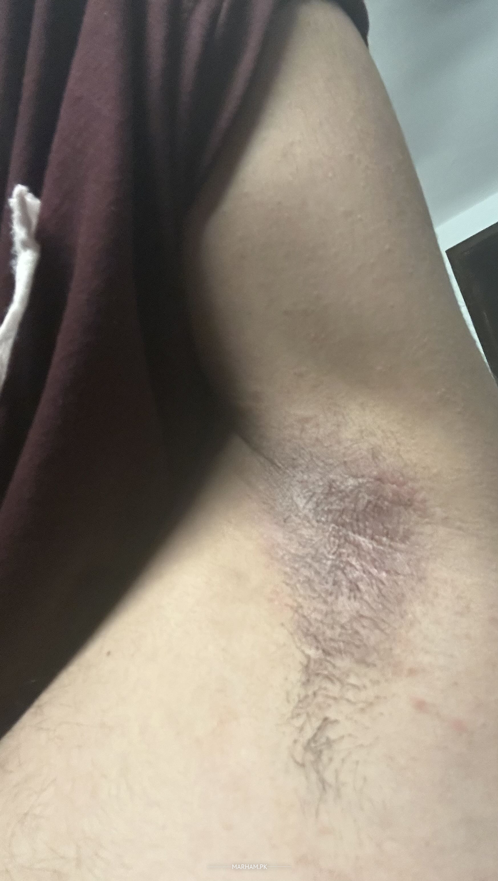 Ask a Dermatologist Online for Under Arm Rash