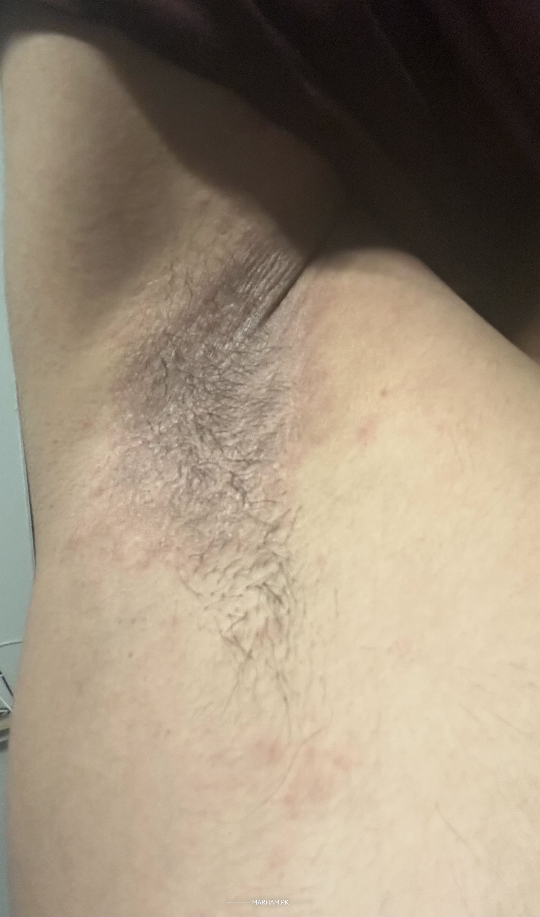 Ask a Dermatologist Online for Under Arm Rash