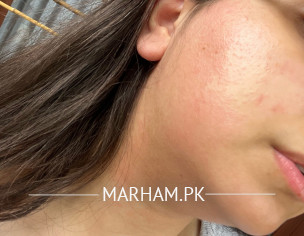 Ask a Dermatologist Online for Rash On Skin In Indonesia