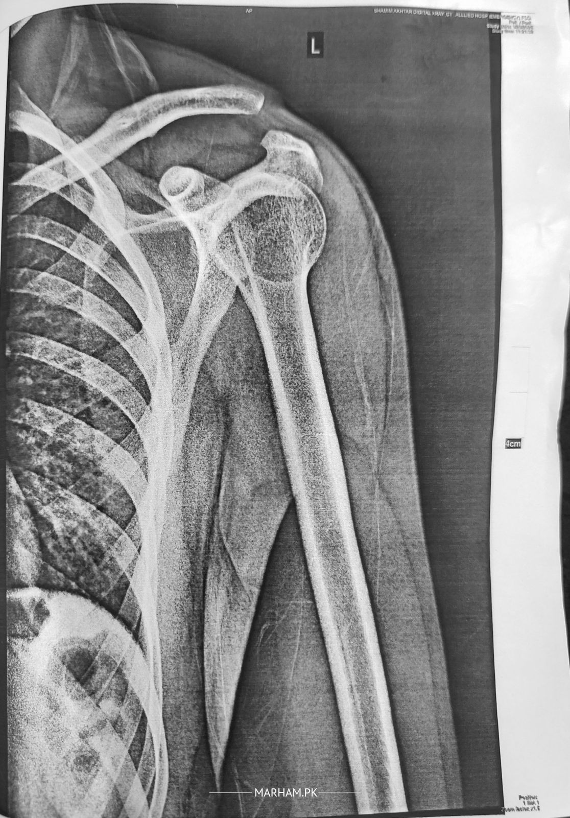 Ask a Orthopedic Surgeon Online for Ac Joint Dislocation