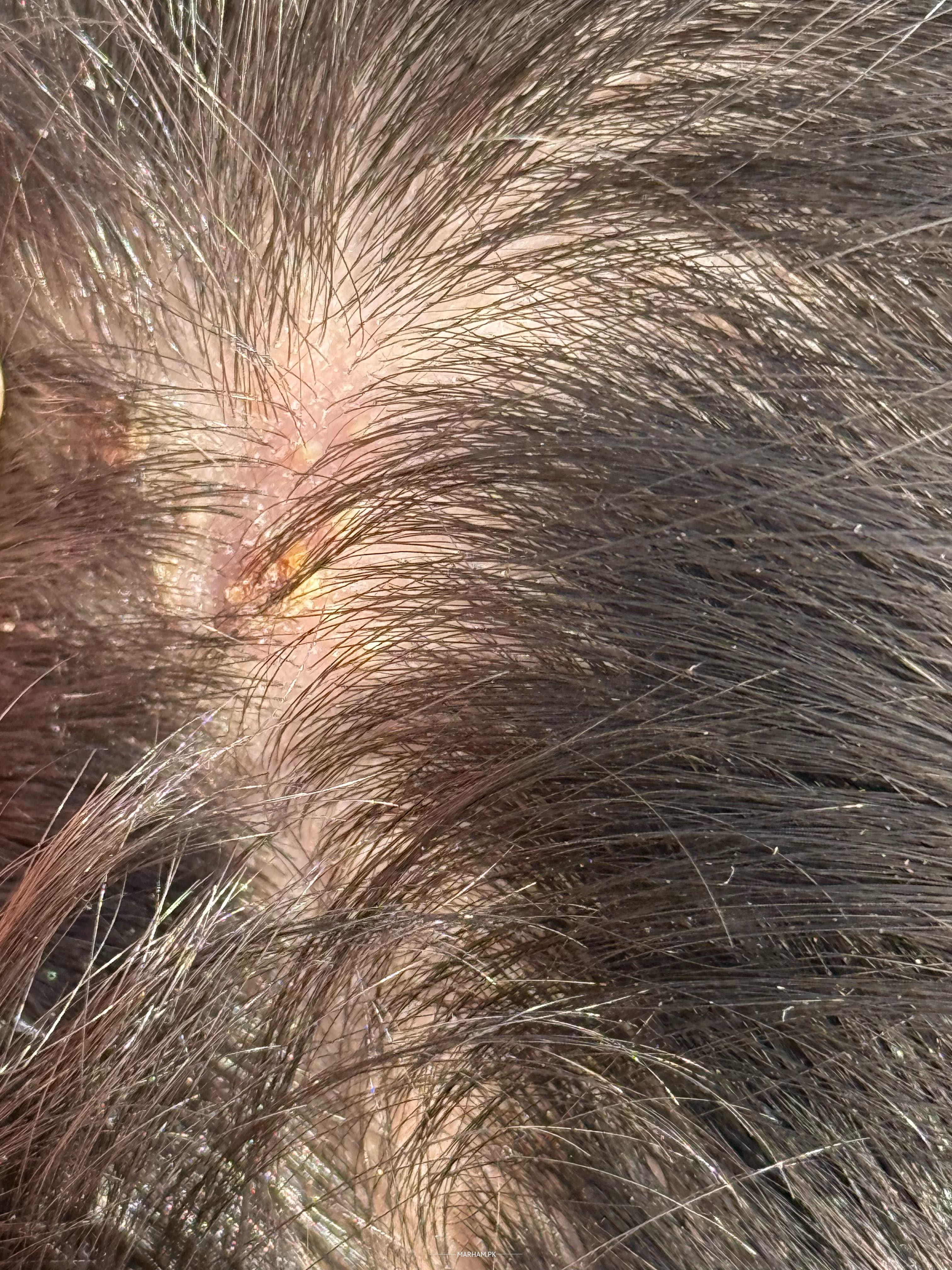 Ask a Pediatrician Online for Little Bumps On Head