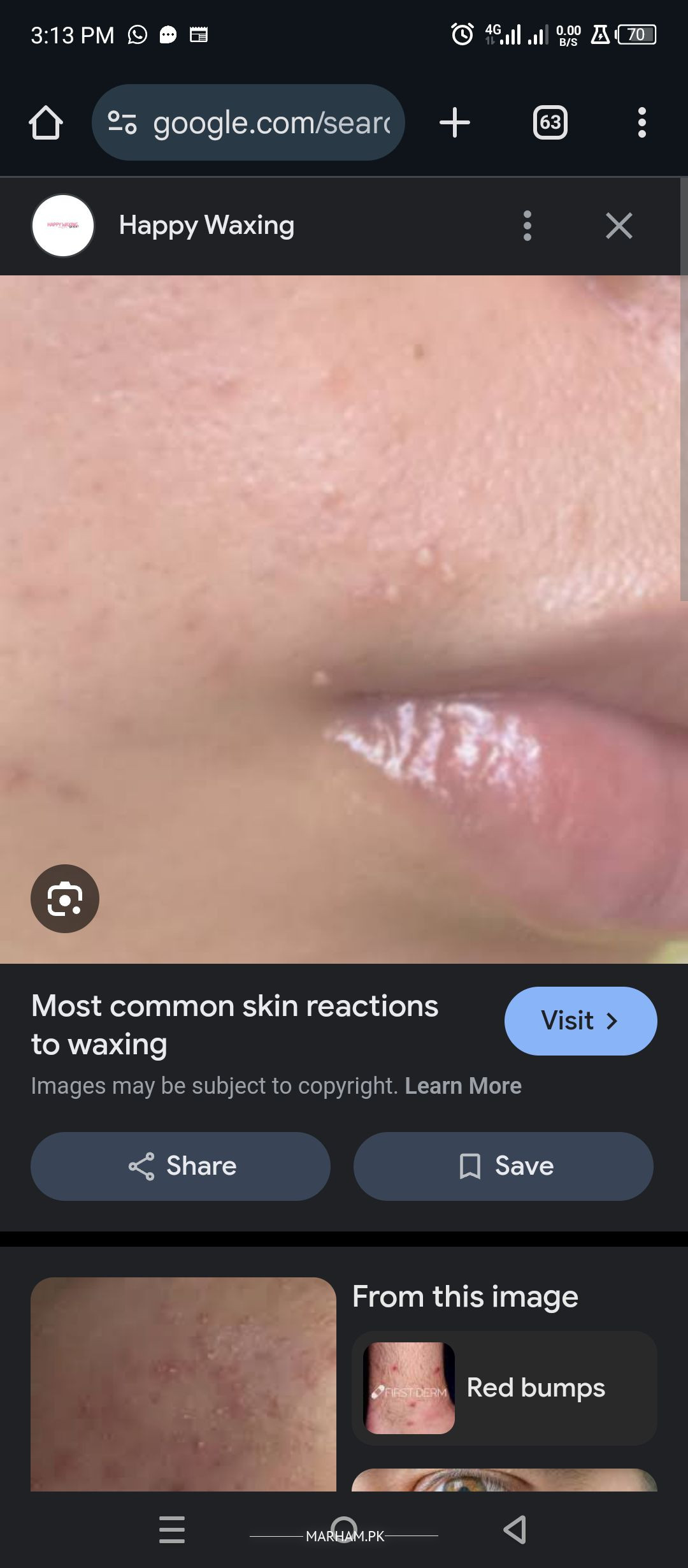 Ask a Dermatologist Online for Small Bumps After Threading