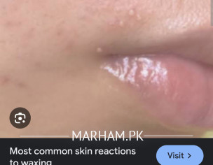 Ask a Dermatologist Online for Small Bumps After Threading