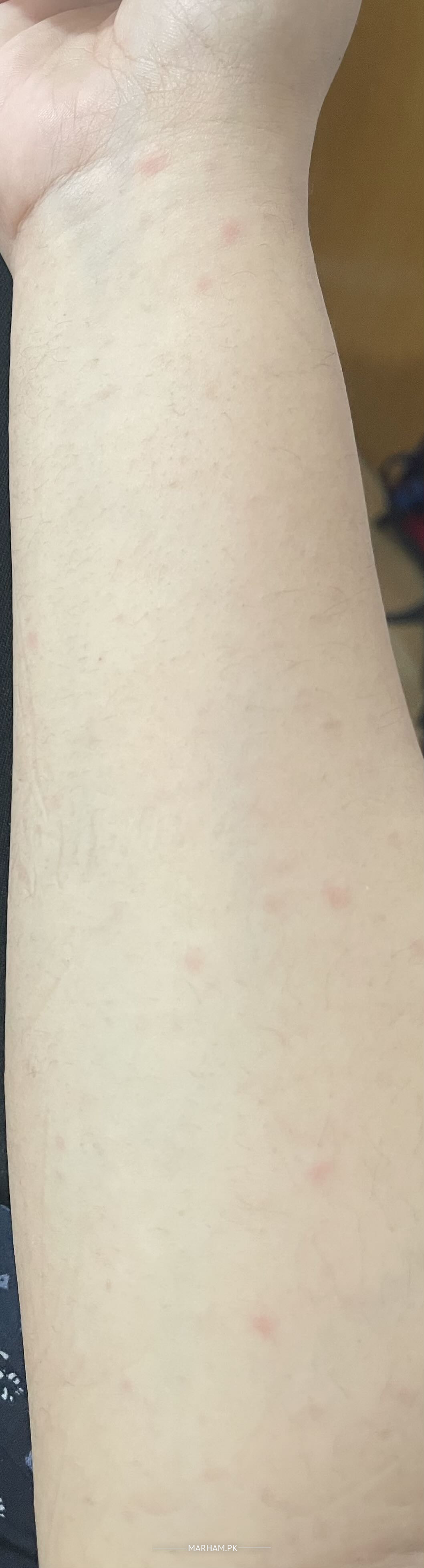 Ask a Dermatologist Online for Red Bumps/rash