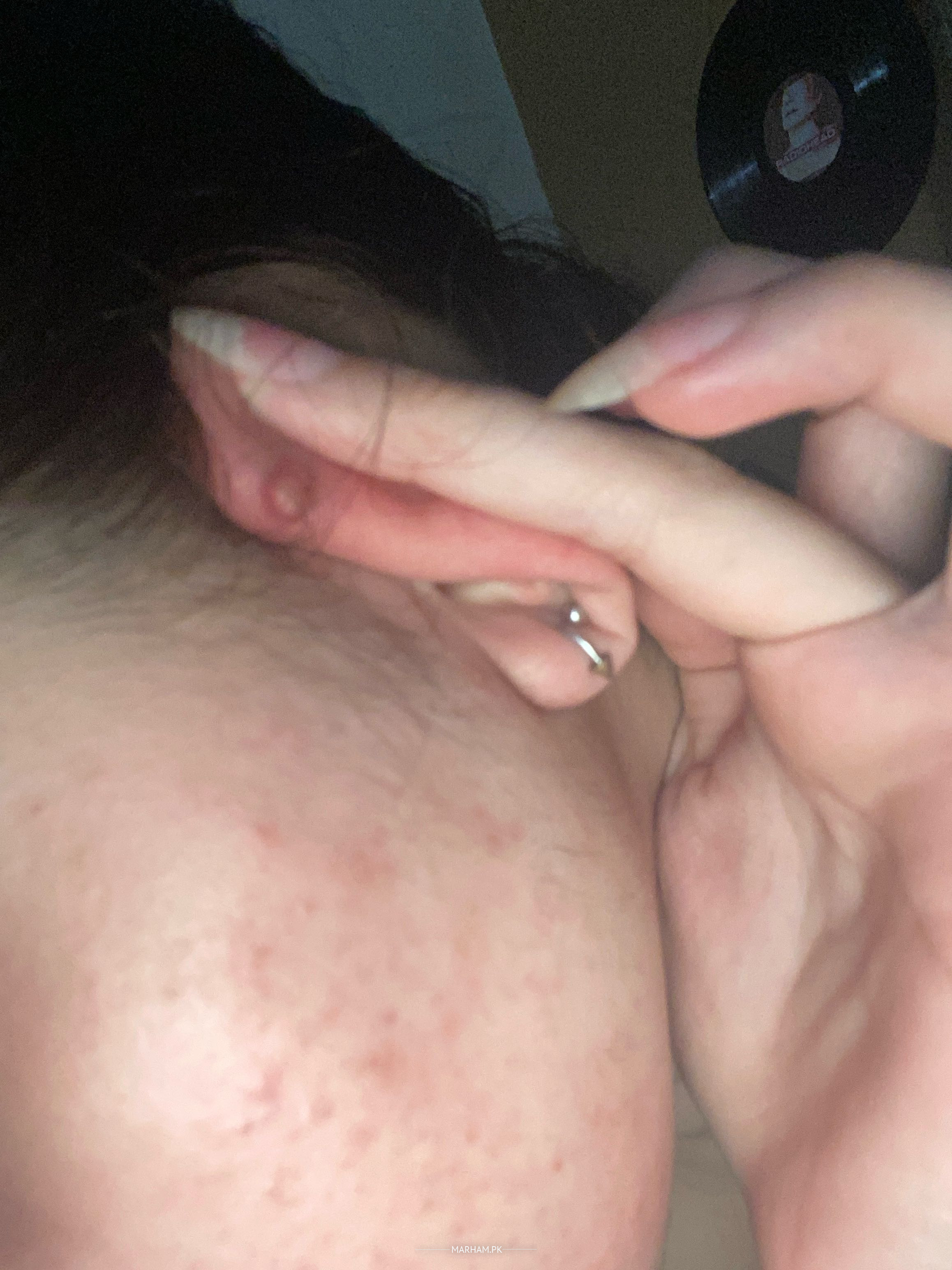 Ask a General Physician Online for Ear Piercing Infection