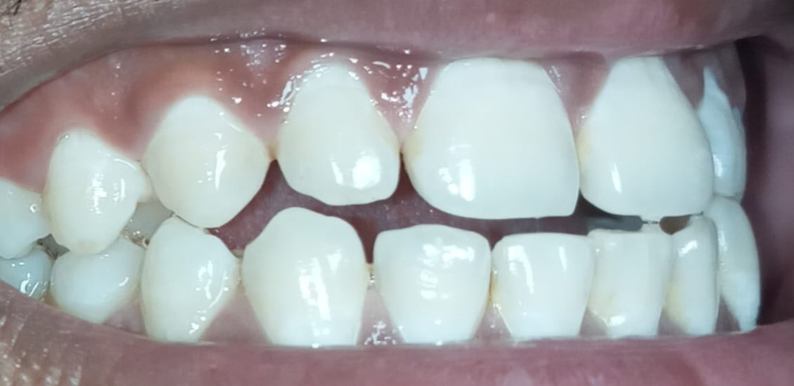 Ask a Dentist Online for Small Gap Between My Front Teeth Also Lower